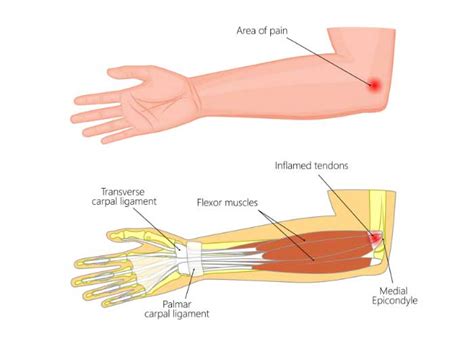 Medial Epicondylitis Golfers Elbow Flexor Mass Tendon Tear Orthopedic Elbow Specialist