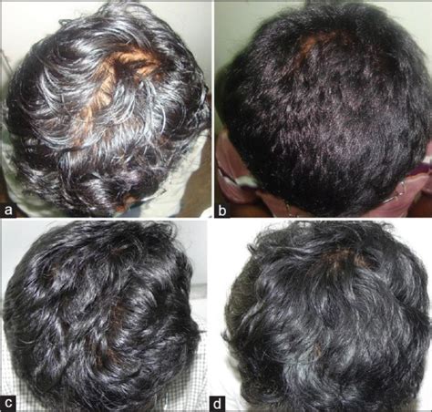 Topical Minoxidil Fortified With Finasteride An Account Of Maintenance Of Hair Density After