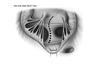 Management Of Vsd Pptx