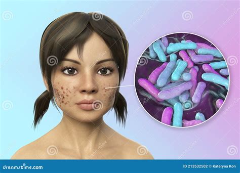 Acne Vulgaris En La Piel Y Primer Plano Vista De Bacterias