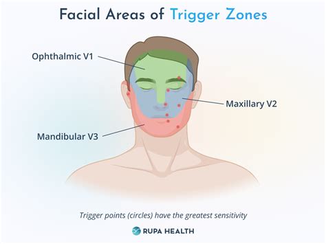 Trigeminal Neuralgia Trigger Points Trigeminal Neuralgia Trigger Points