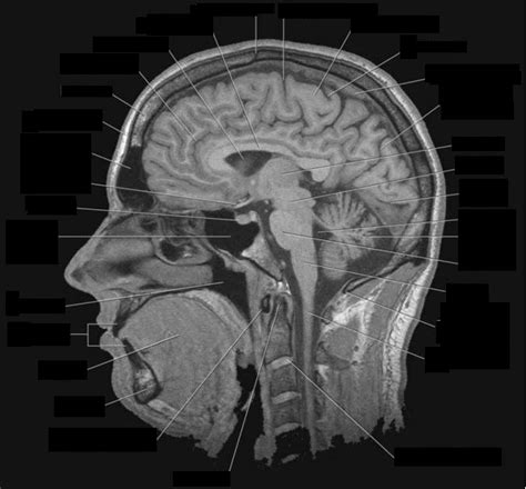 Sagittal Brain Mri