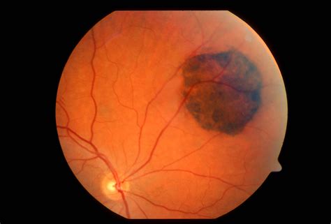 Pigmented Retinal Lesions