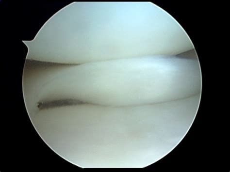 Medial Meniscus Tear Displaced Arizona Institute For Sports Knees
