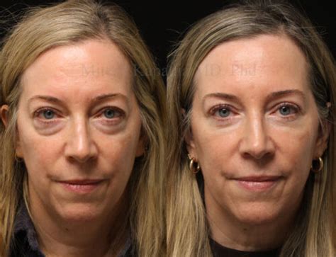 Before And Two Weeks After Upper Blepharoplasty Surgery Boston Eyelid