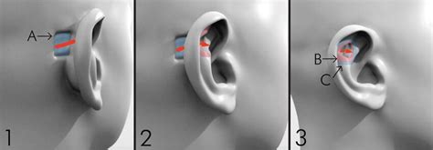 1a—postauricular Flap Marking 2—cartilage Tunnel 3b—defect Site