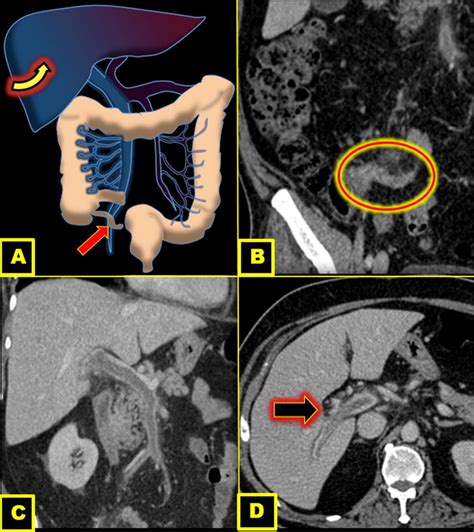 Appendix Vermiformis Straight Arrow Drains To Smv A Appendicitis Download Scientific