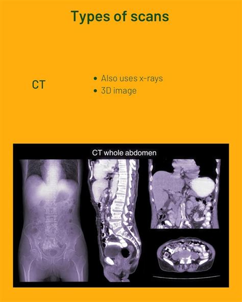 What Is The Point Rsciatica