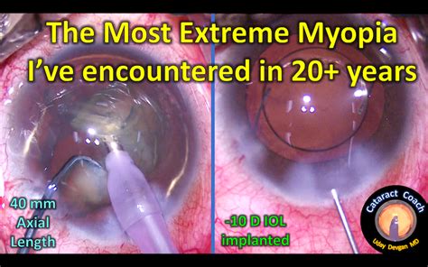 The Most Extreme Myopia That Ive Seen In 20 Years Cataract Coach