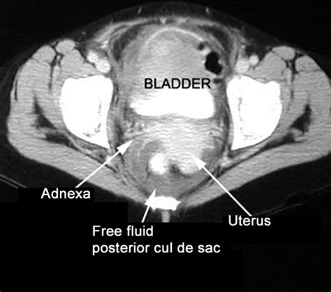 Ascites