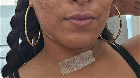 Day 2 Thyroidectomy Healing Journey Youtube