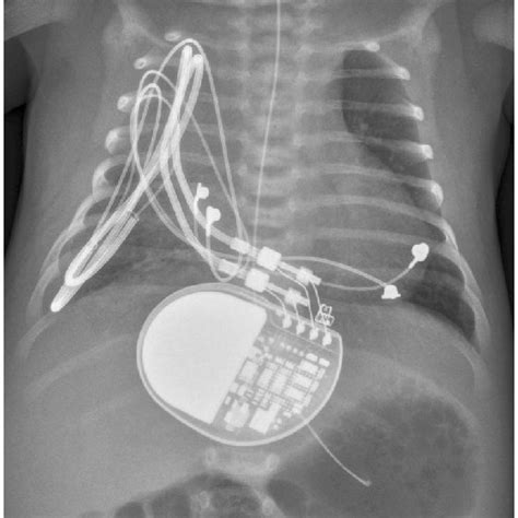 Pdf Pacemaker Implantation In Neonates And Infants Favorable Outcomes With Epicardial Pacing