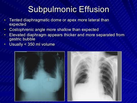 Chest Radiology In Intensive Care