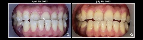 3 Months Progress R Invisalign