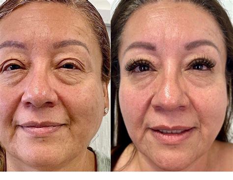 Eyelid Lift Jet Plasma Treatment To Lift Eyelids Quickuk
