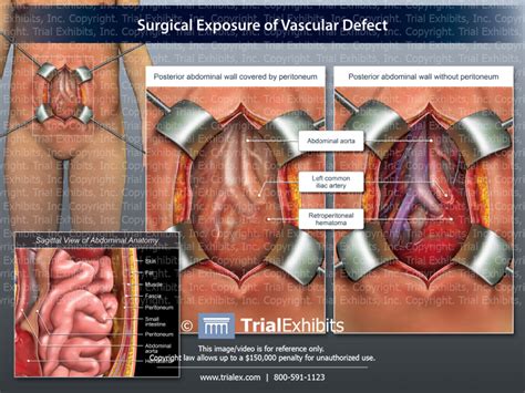 Surgical Exposure Of Vascular Defect