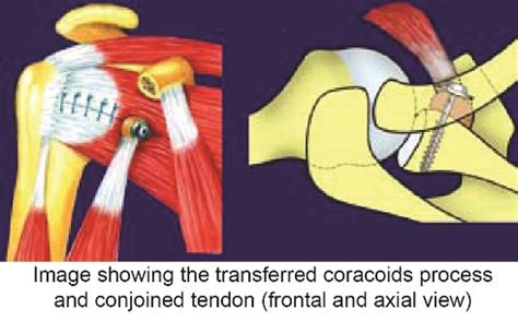 Latarjet Rehab Guidelines A New Guide For The Arthroscopically
