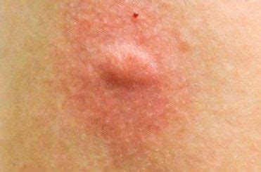 German Cockroach Bite Marks