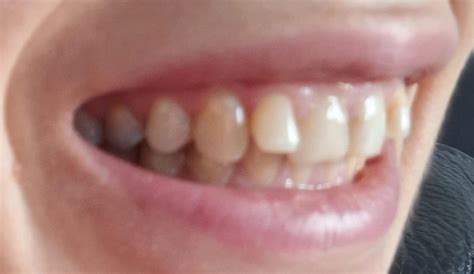 Does This Look Like Overjet Or Overbite R Braces