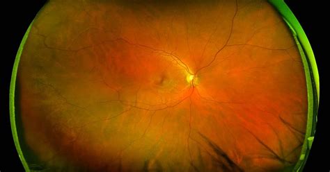 Fluorescein Angiography Essential To Identify Retinal Vasculitis