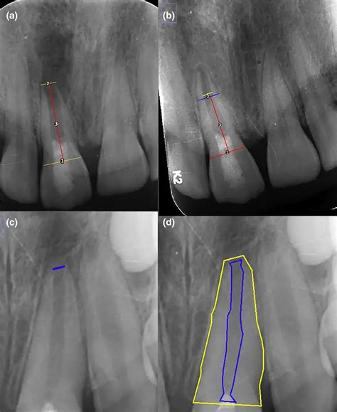 The Effect Of Prf In Regenerationrevitalization Endodontics
