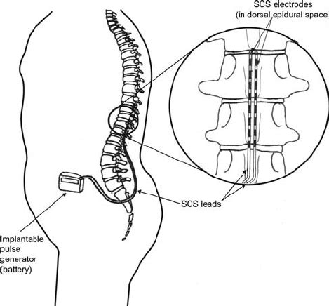 X Ray Showing Implanted Scs System Download Scientific Diagram