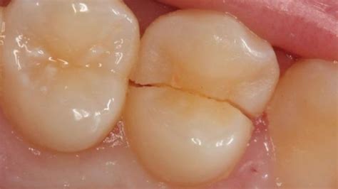 Chipped Teeth Type Prevent And Treatment In Bassendean