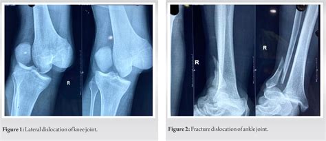 Ipsilateral Knee Dislocation And Ankle Fracture Dislocation Journal Of Orthopaedic Case Reports