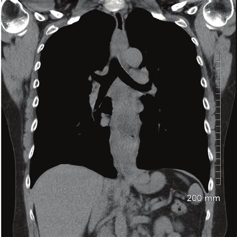 The Egd Reveals This Friable And Fungating Mass 30 Cm From The Incisors Download Scientific