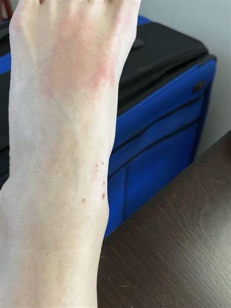 Bed Bugs Fleas Something Else Rbugbites