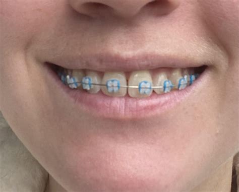 6 Months Progress Bottom Brackets Next Visit Rbraces