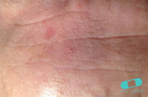 Actinic Keratosis Ak Online Dermatology