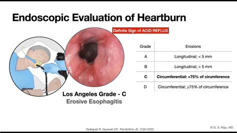 Gerd Endoscopic Evaluation Esophageal Mucosa Youtube