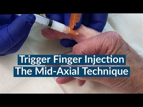 Trigger Finger Injection The Mid Axial Technique Youtube