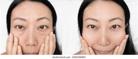 80 Thousand Eye Lift Asian Before After Royalty Free Images Stock