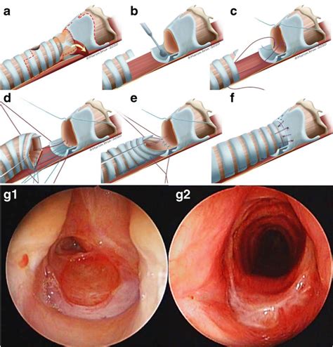 Surgical Steps Of Single Staged Partial Cricotracheal Resection And Download Scientific Diagram