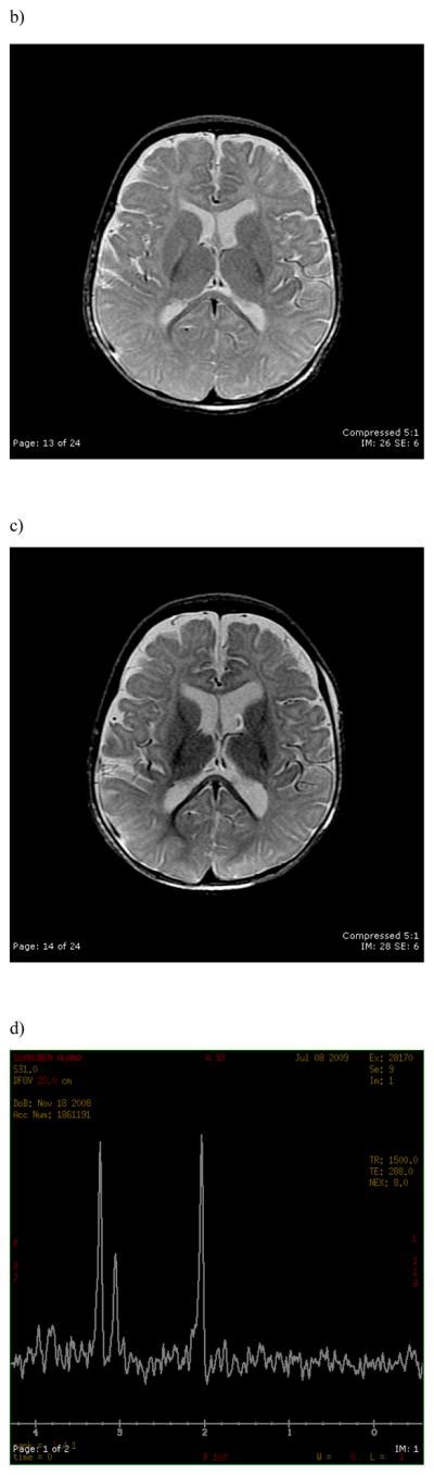 Novel Scn1a Mutation In A Proband With Malignant Migrating Partial