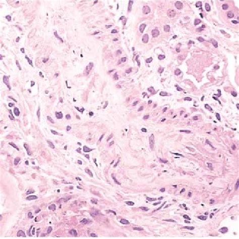 Small Renal Cortical Artery Showing Marked Mucoid Intimal Thickening