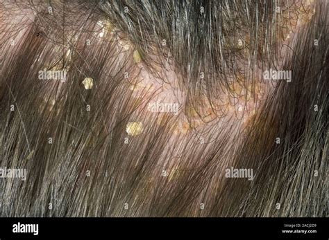 Flaking And Scaling Skin On The Scalp In A 4 Year Old Male Patient Due To Psoriasis Psoriasis