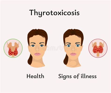 Thyrotoxicosis Thyroid Gland Medical Poster Stock Vector Illustration Of Thyrotoxicosis