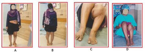 Figure 1 From Deformity Correction Upper Tibial Bone Defect Due To Osteomyelitis In Lower Limb