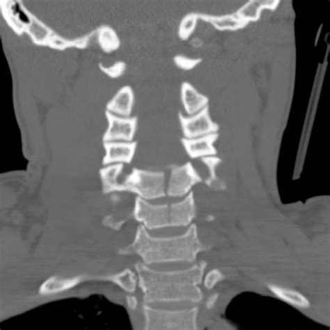 Cervical Spine Hyperflexion Injuries By Alexander Baxter