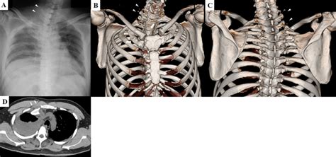 Posterior Sternoclavicular Joint Dislocation With Thoracic