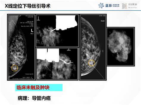 乳腺x线摄影在乳腺癌早筛早诊中的应用价值全网影像解剖图