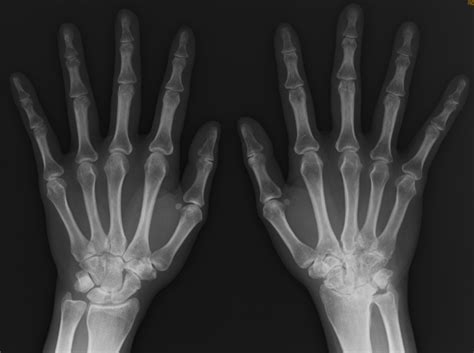 リウマチによる手首の変化の一例 ふかや内科リウマチクリニックブログ