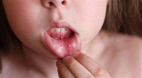 Tous Nos Conseils Pour Soigner Et Soulager Les Aphtes