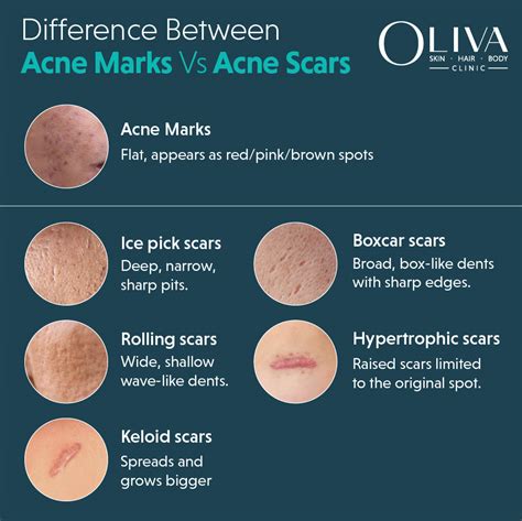 Acne Scars Boxcar