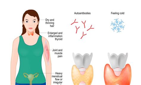 ThyroÏdite De Hashimoto Causes Symptômes Et Traitements Esculape