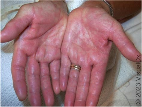 Diffuse Rash Followed By Erosions On The Lips And Mouth The Journal