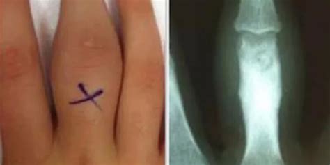 What Is Osteoid Osteoma Symptoms And Treatment Methods Doçdr Özgür Erdoğan